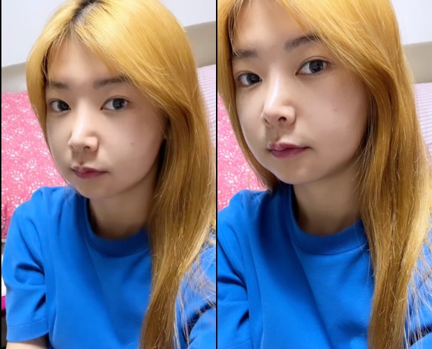 나는 솔로 10기 영자, 양악 수술 후 회복 중 셀카…“얼짱 각도” - 노지현 기자 - 톱스타뉴스